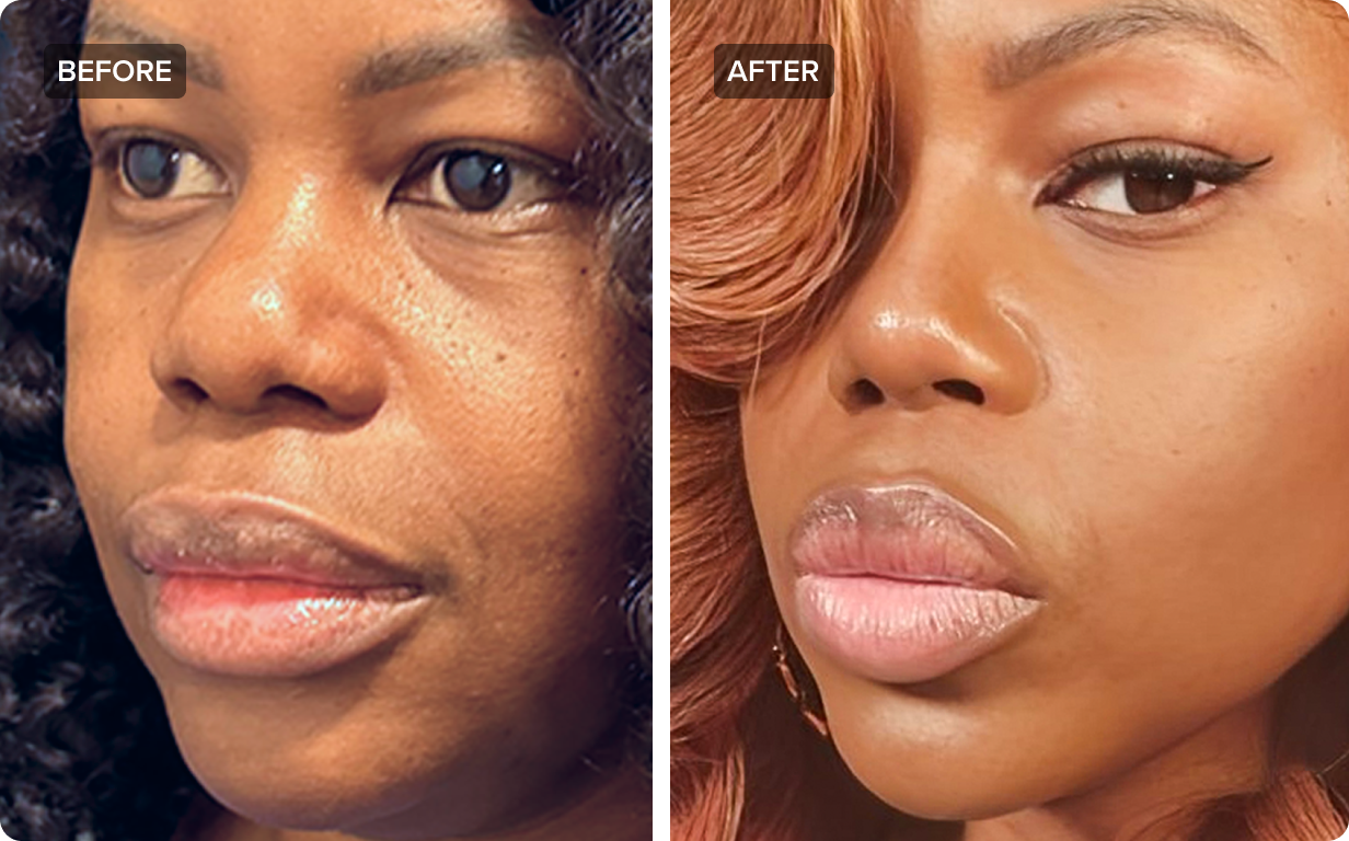 Black Nose Job Black Nose Job In Korea: Honest Thoughts And Review