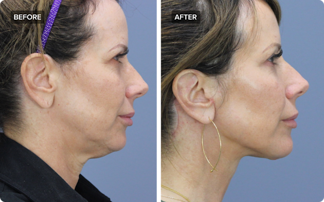 Neck Lift Surgery: The Ultimate Guide | RealSelf