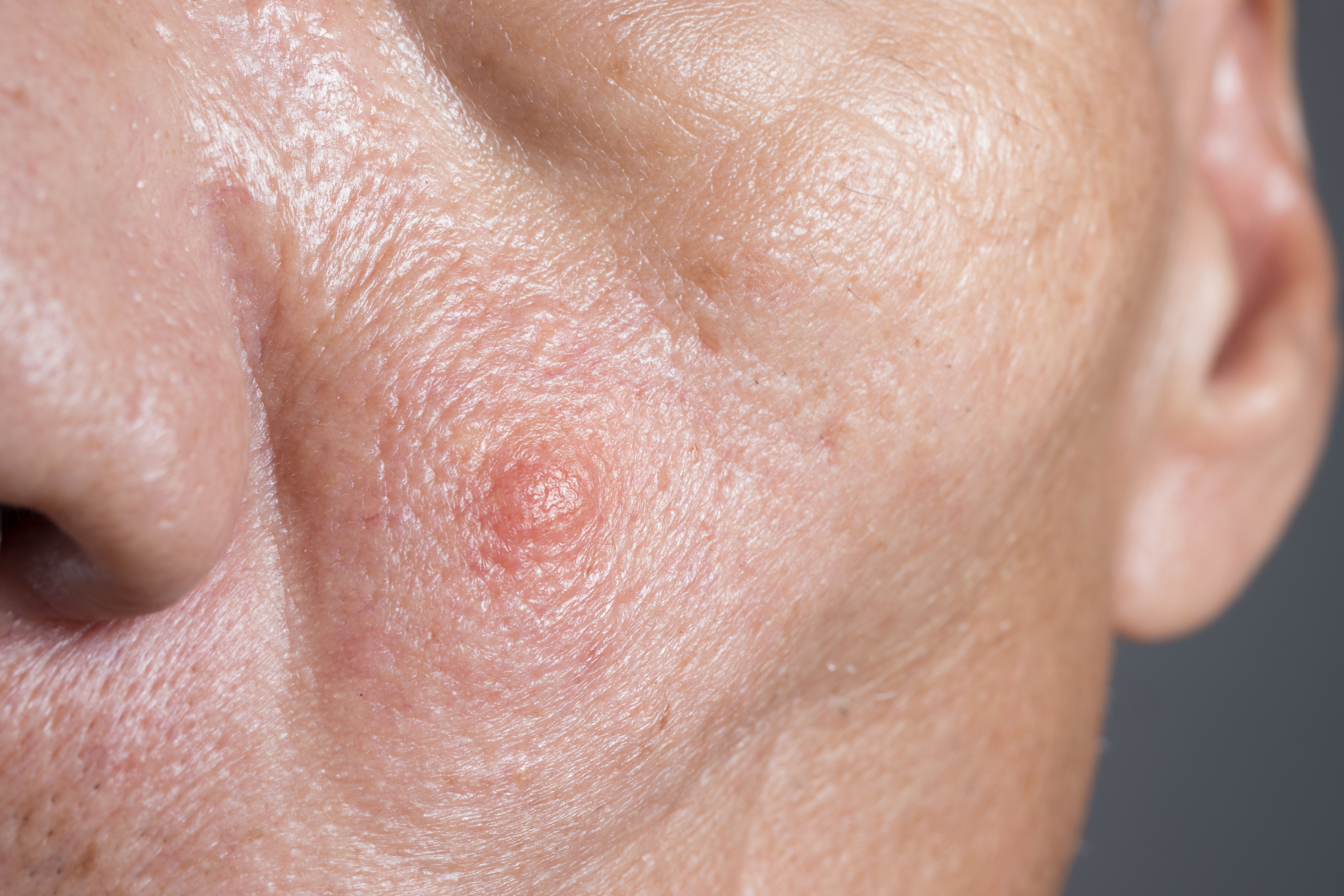Basal Cell Carcinoma - Diagnosis & Treatment | LIPS Healthcare