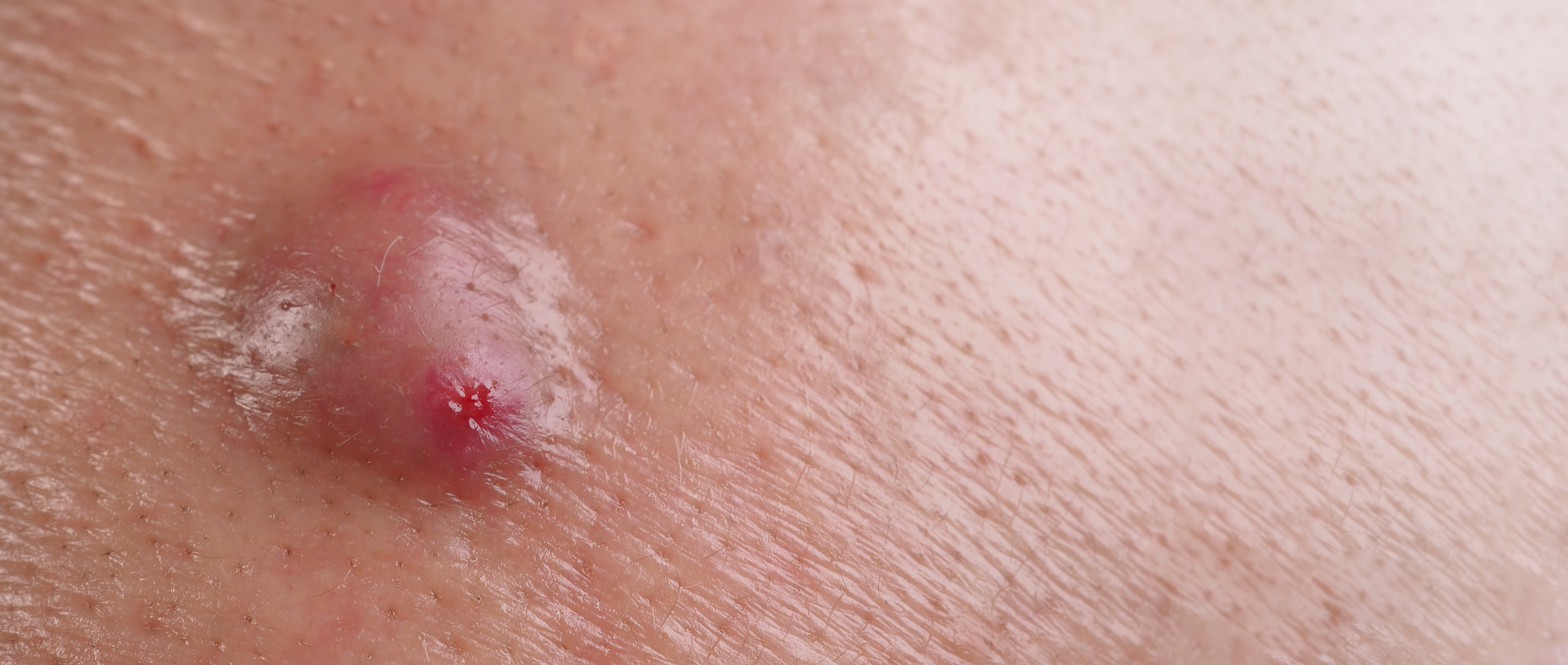 Skin Lumps & Bumps Removal at Battersea | Cysts | Lipoma