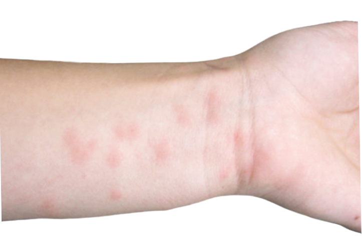 Bältros - orsak, symtom och behandling | Dr Hud