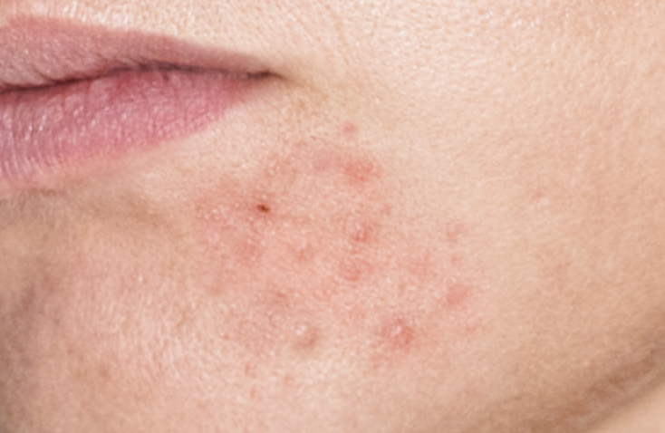 Perioral dermatit - orsak, symtom och behandling | Dr Hud