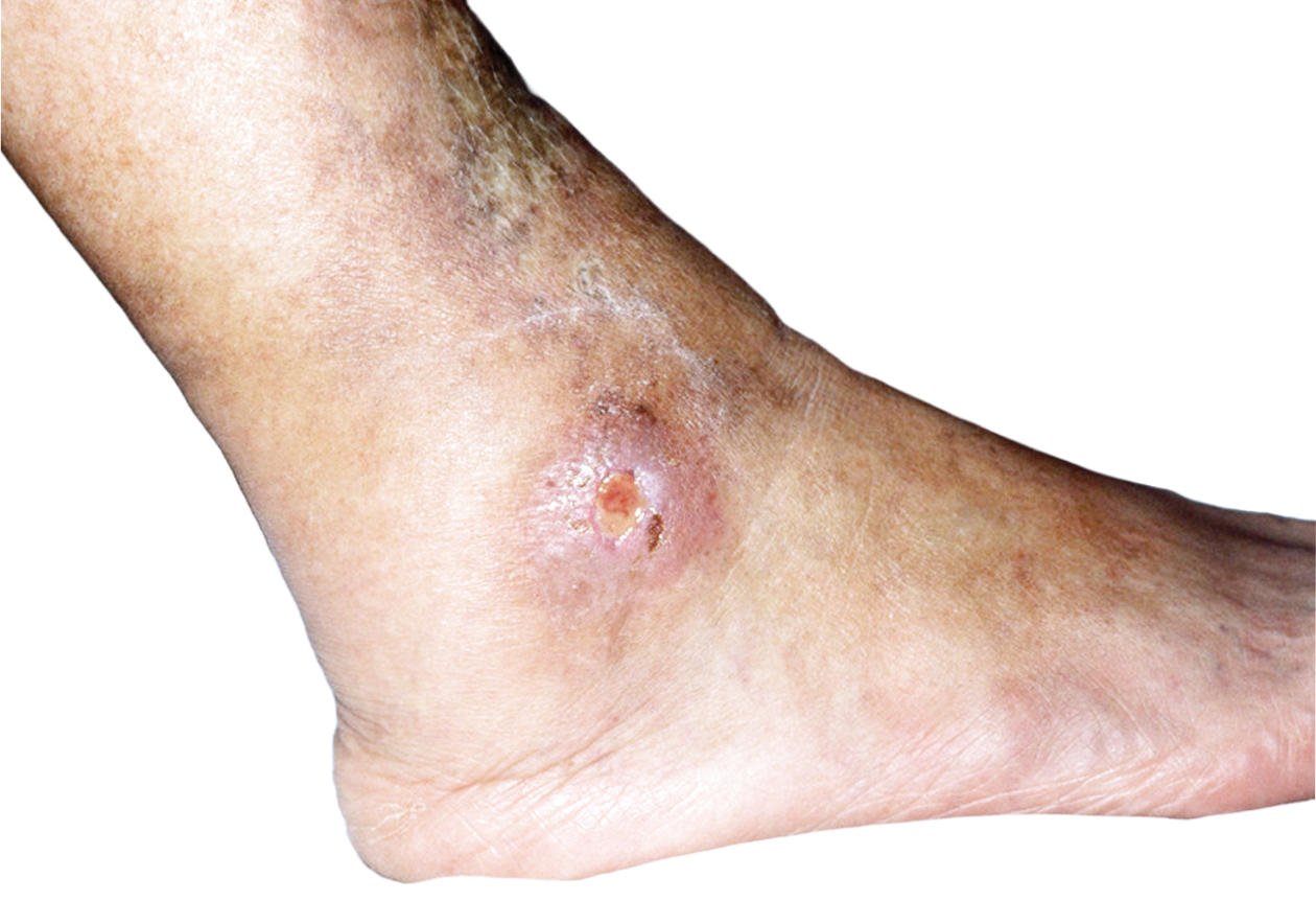 Hudsjukdomar A-Ö - lär dig mer om symtom och behandling