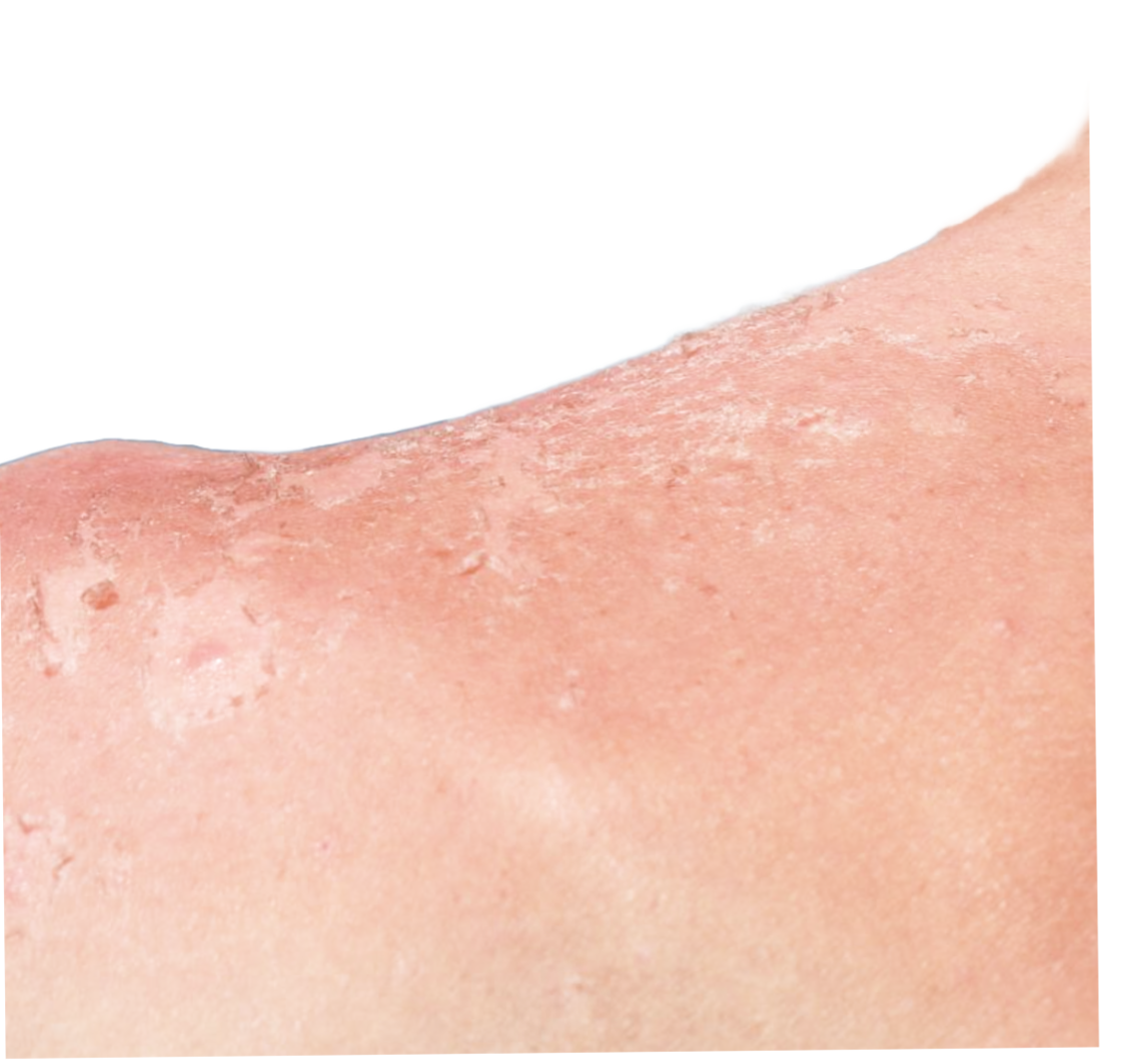 Vitiligo - orsak, symtom och behandling | Dr Hud