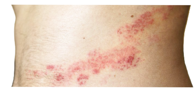 Hudinfektion - orsak, symtom och behandling | Dr Hud