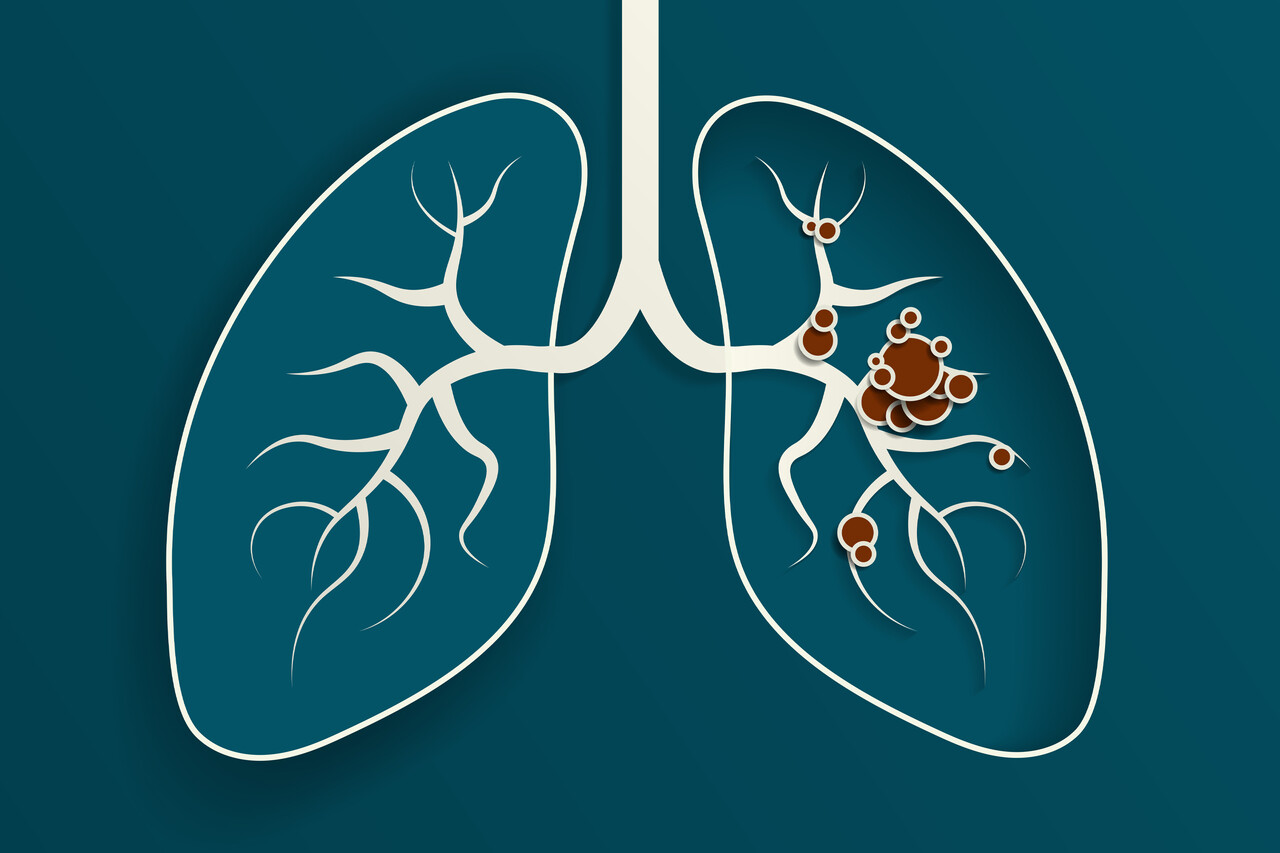 Immunochemotherapy Confirmed as First-Line Standard for Some SCLC