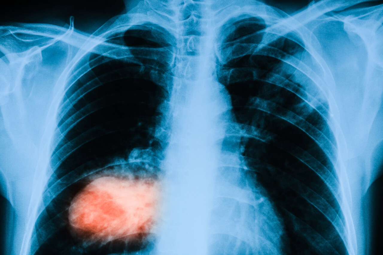 FDA Approves Amivantamab (Rybrevant) Plus Chemo for EGFR-Mutated ...