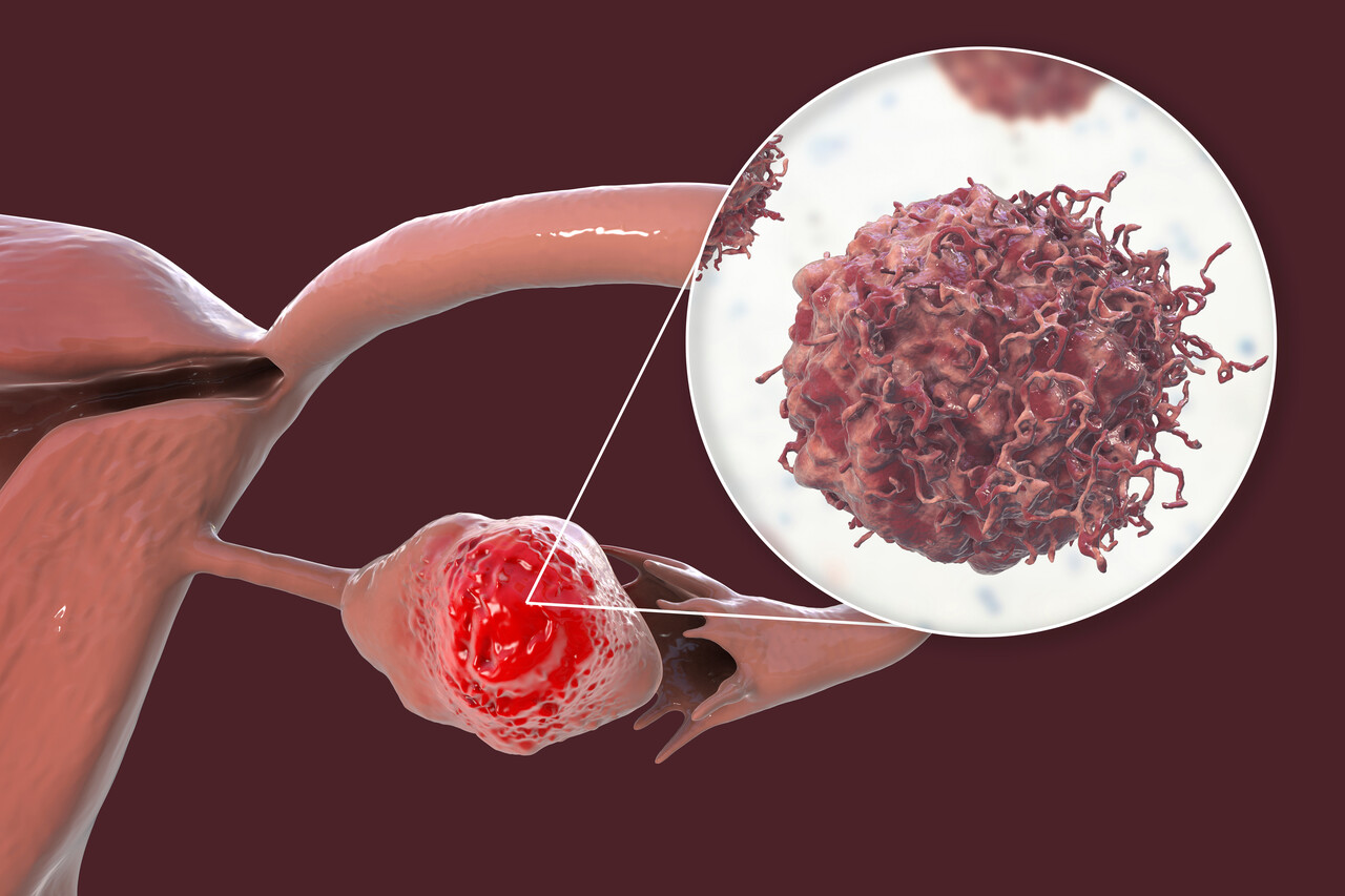 Lymphadenectomy Can Be “Shaken Off” in Ovarian Cancer, Phase 3 Data Show