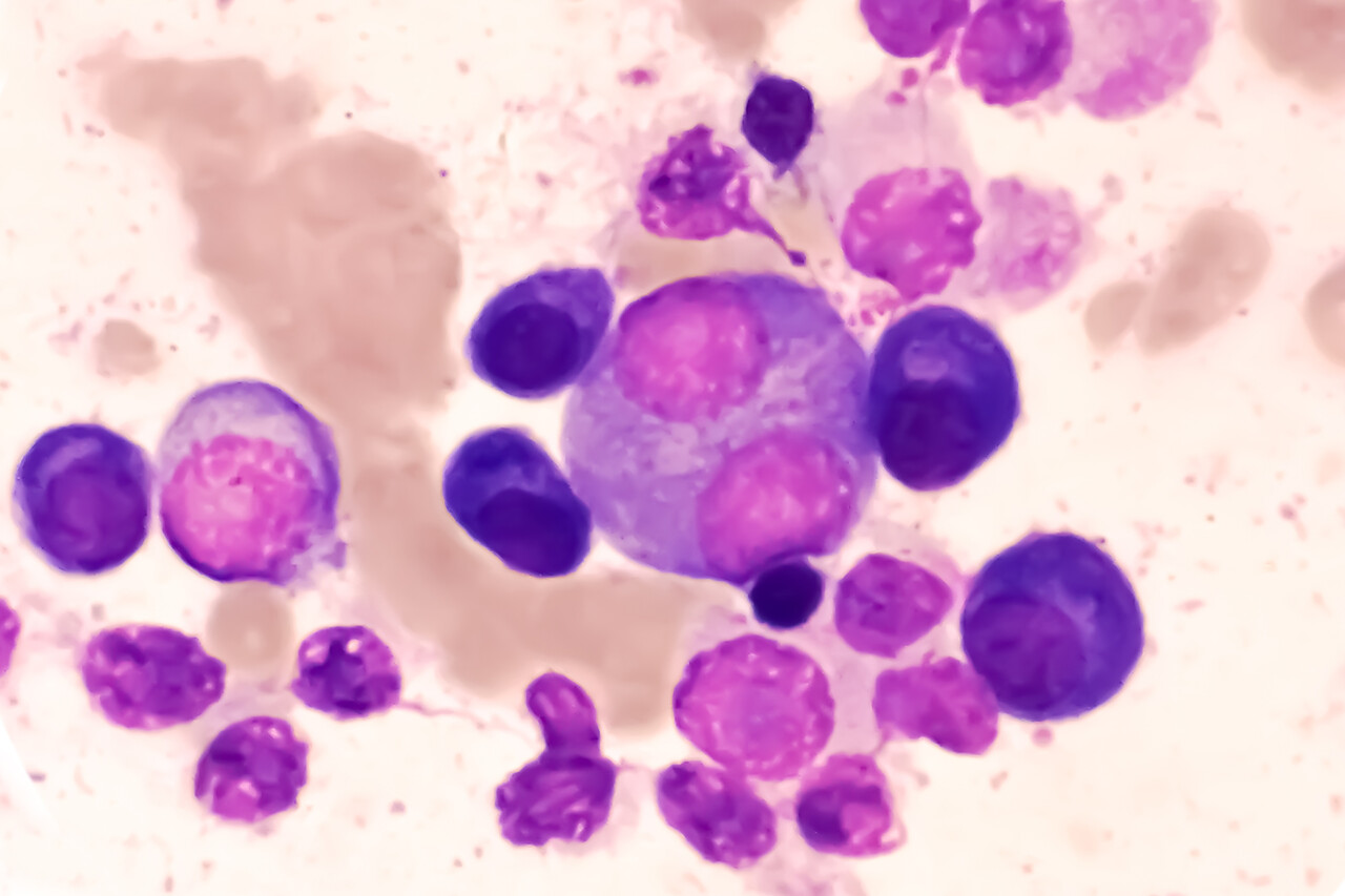FDA Approves Teclistamab (Tecvayli) Combination for Relapsed or ...
