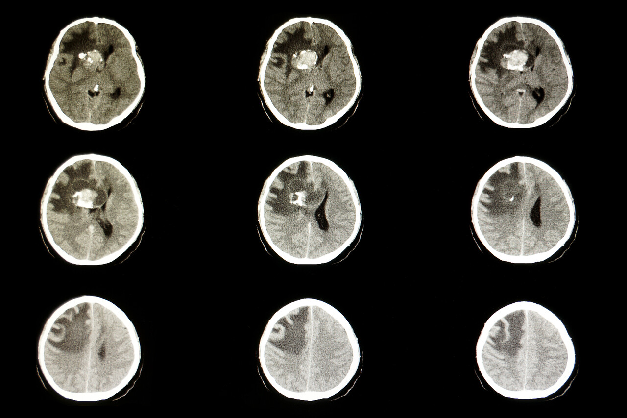 FDA Approves Vorasidenib (Voranigo) for IDH-Mutant, Low-Grade Gliomas