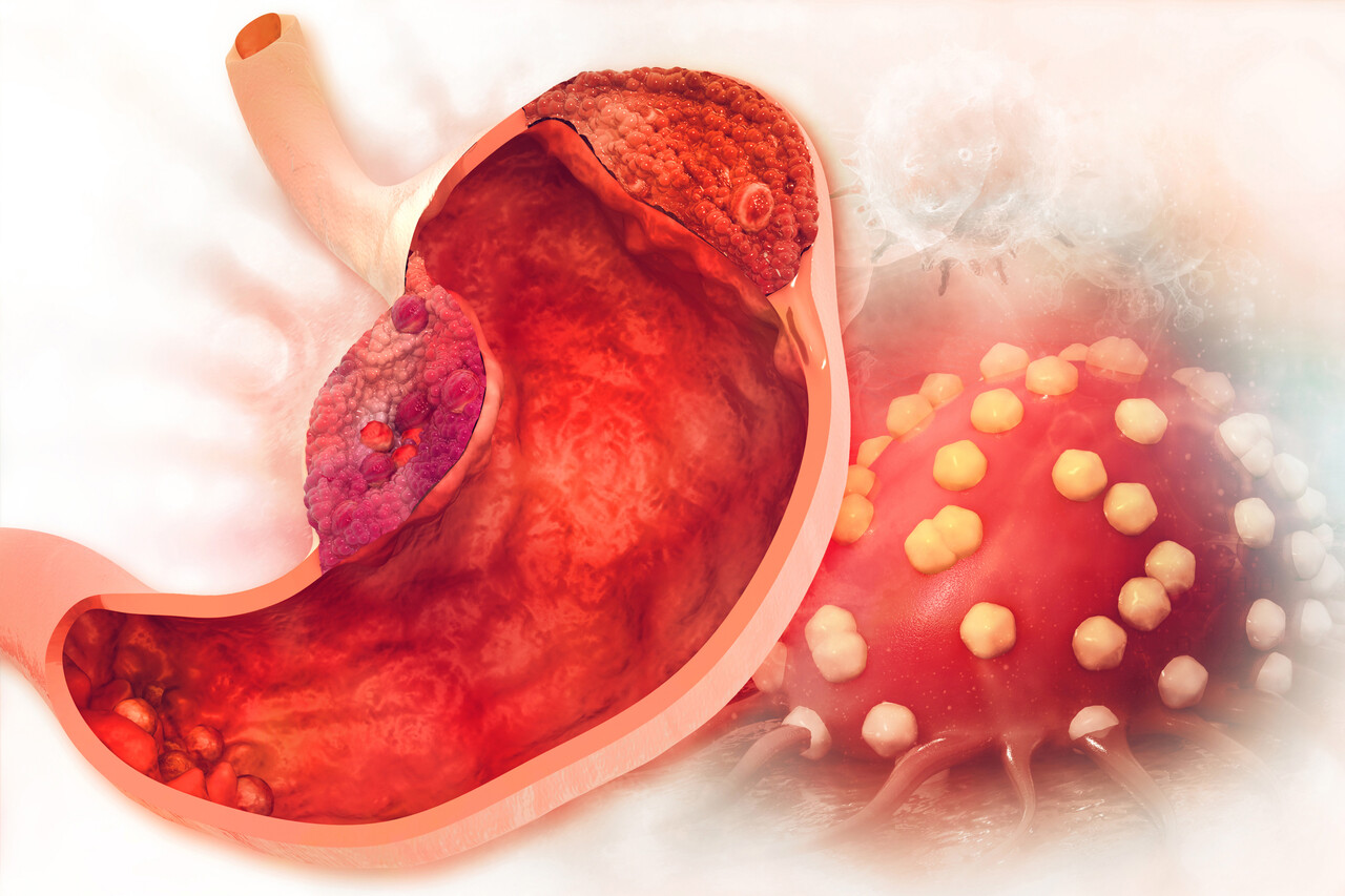 Progress in HER2-Negative Advanced Gastric Cancer