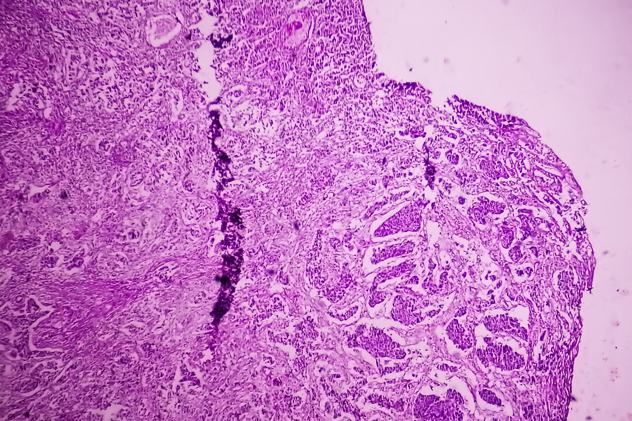 FDA Approves Enfortumab Vedotin Combo for Advanced Urothelial Carcinoma