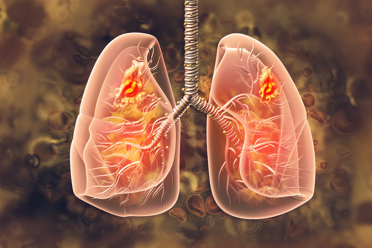 Amivantamab Regimens Present New Options for Certain EGFR-Mutant NSCLC