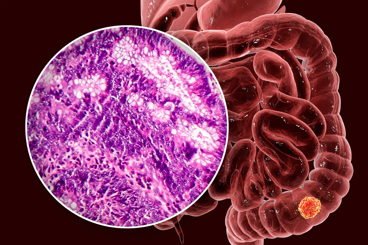 FDA Approves Sotorasib (Lumakras) Combination for Metastatic Colorectal ...