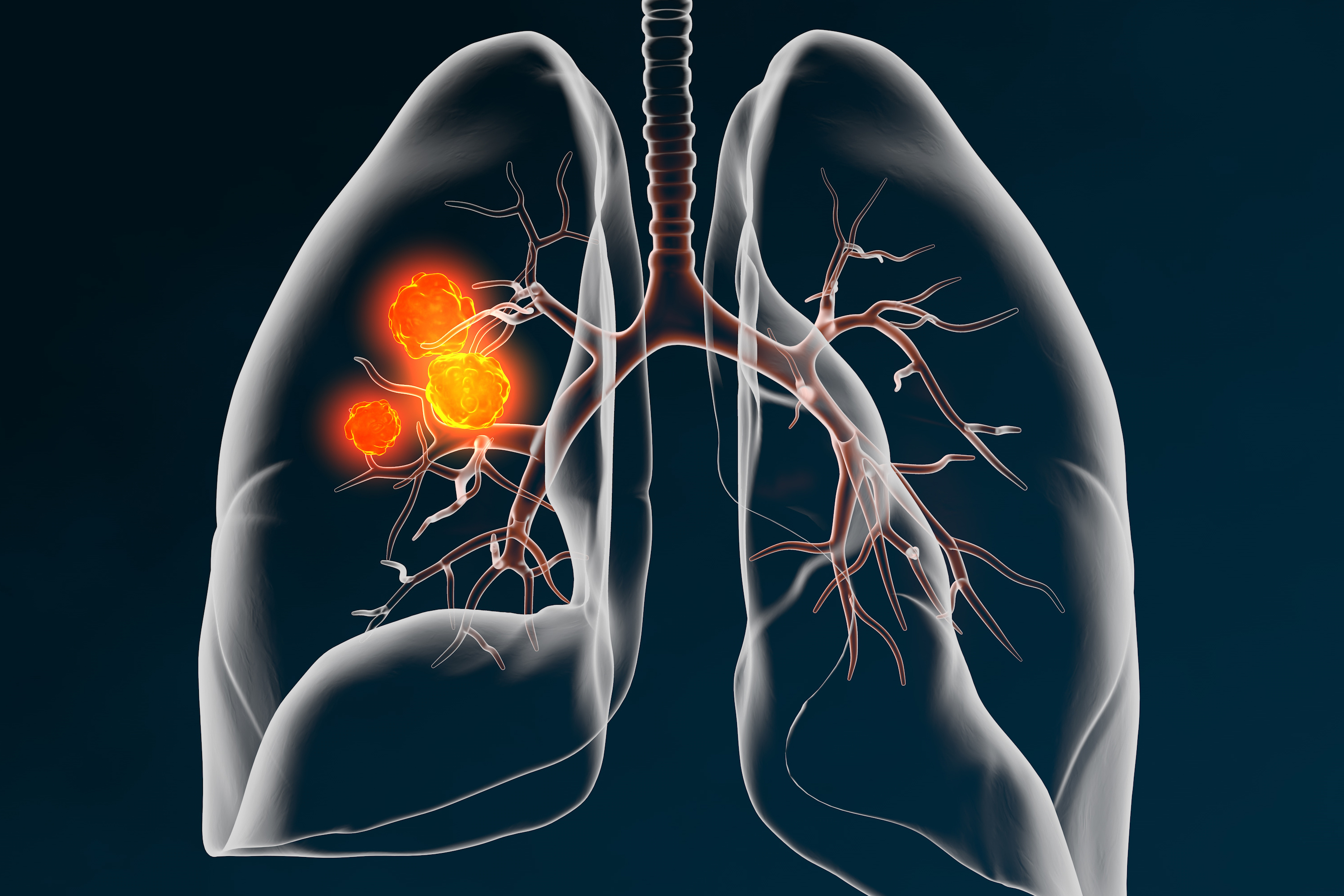 Survival Data From FLAURA2 Back Osimertinib Plus Chemo as First-Line ...