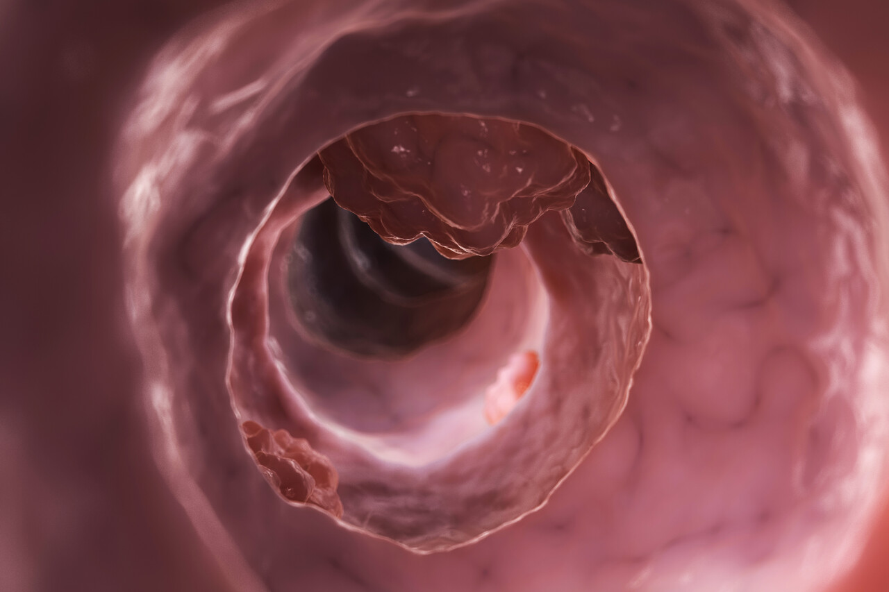 FDA Oks Tucatinib (Tukysa) Plus Trastuzumab for HER2-Positive ...