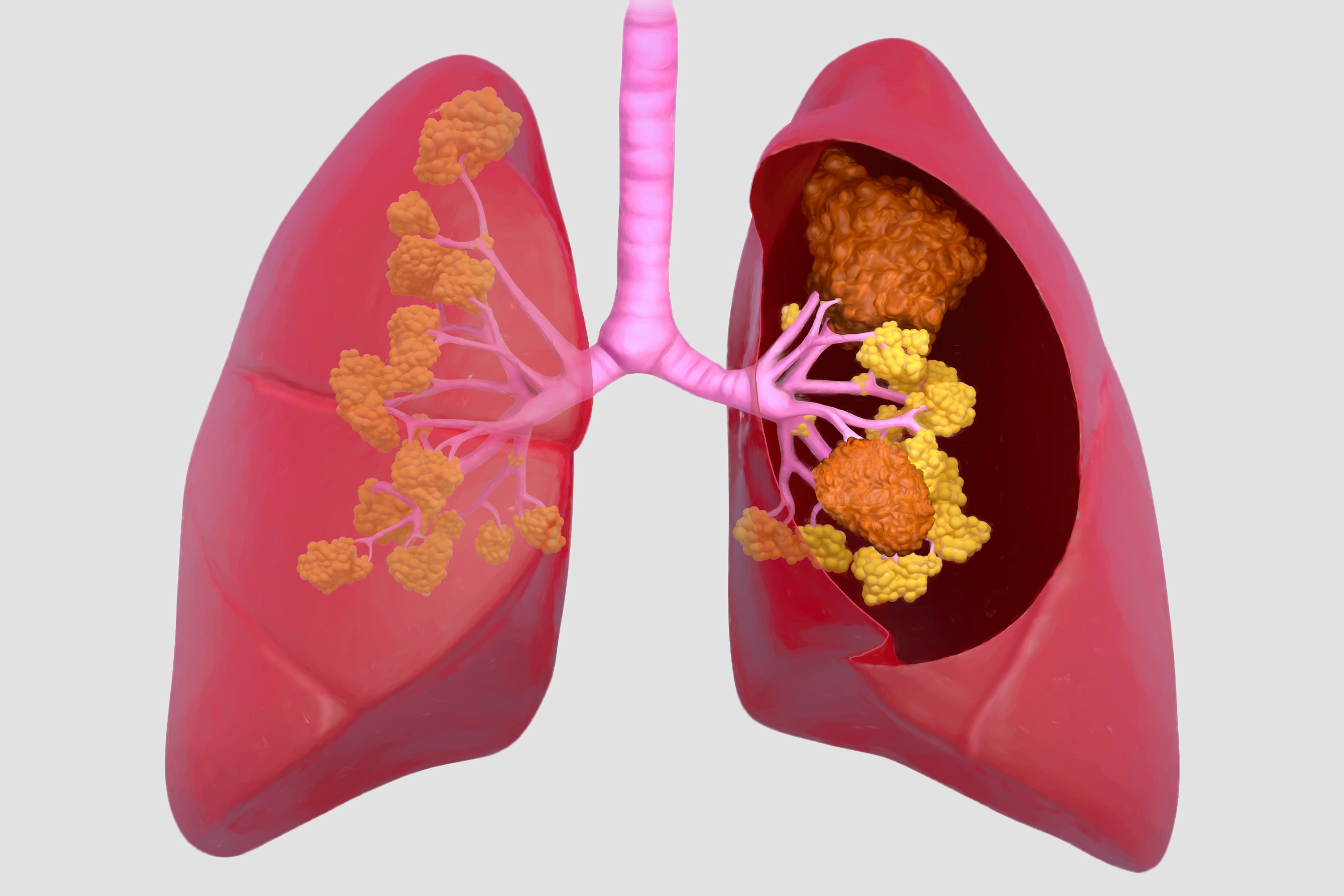 FDA Approves Telisotuzumab Vedotin (Emrelis) for Advanced NSCLC