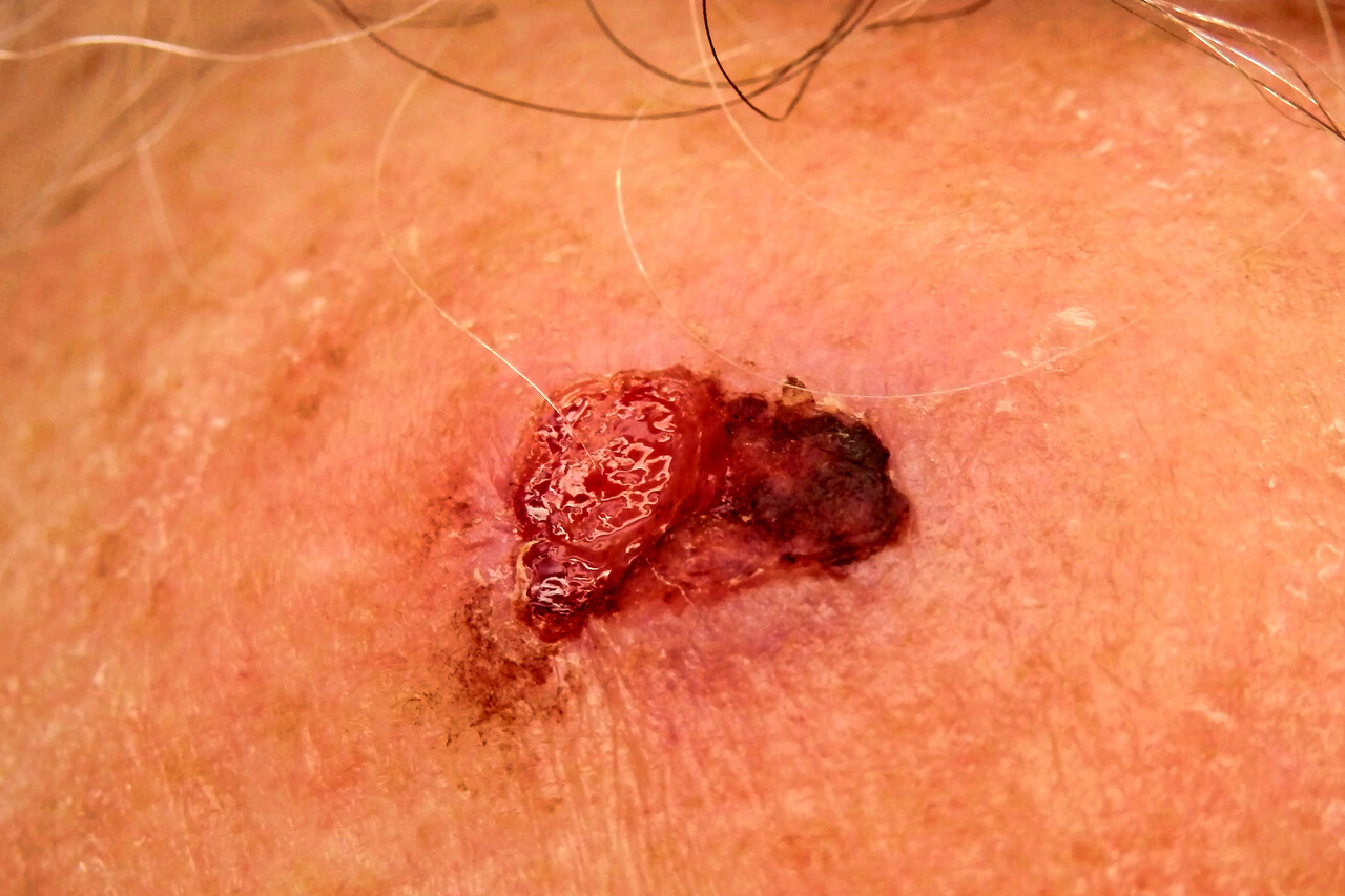 FDA Approves Cemiplimab (Libtayo) for Cutaneous Squamous Cell Carcinoma