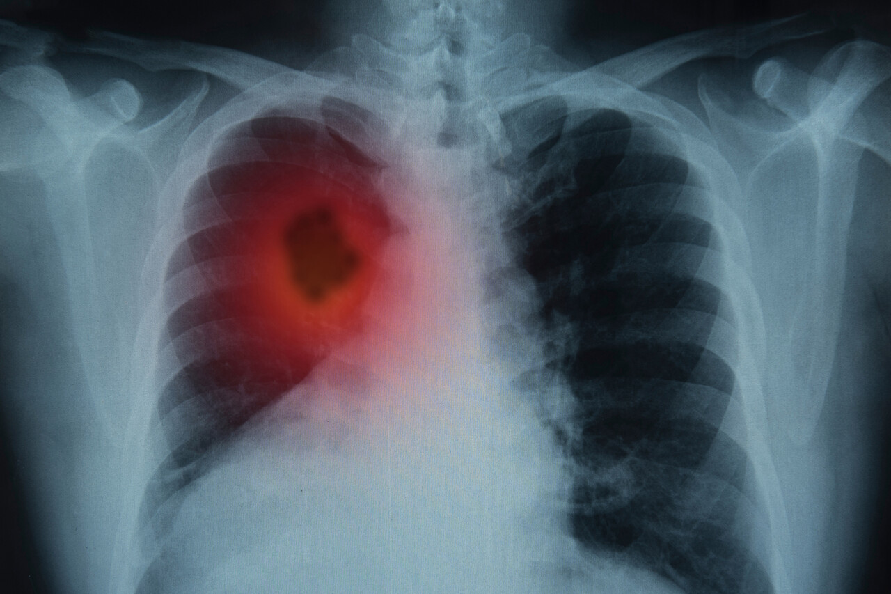 ADC Fails Phase 3 NSCLC Trial: CARMEN-LC03 Data From WCLC 2024