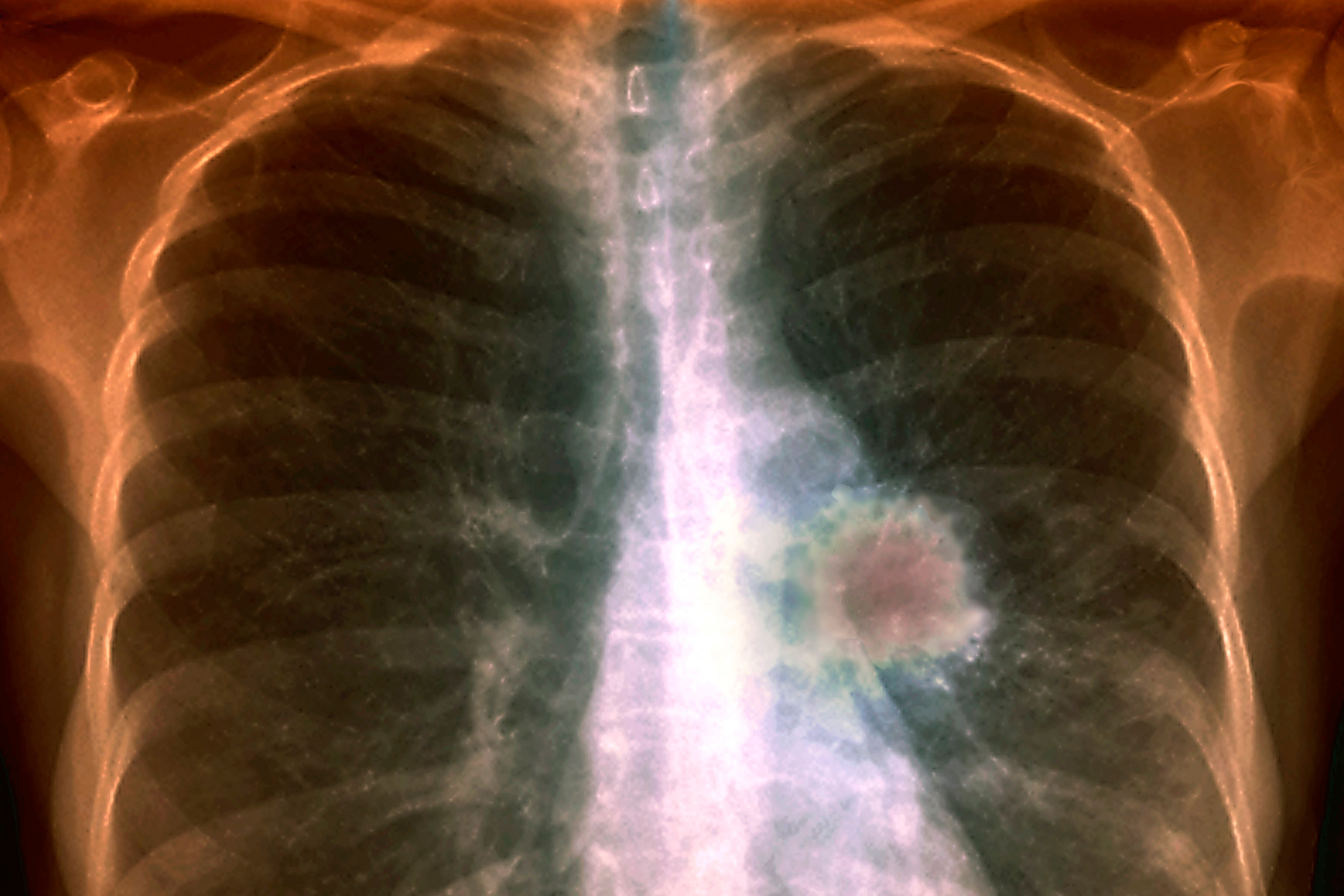 Practice-Changing Data in Lung Cancer From ASCO 2024 Point to Key Concerns