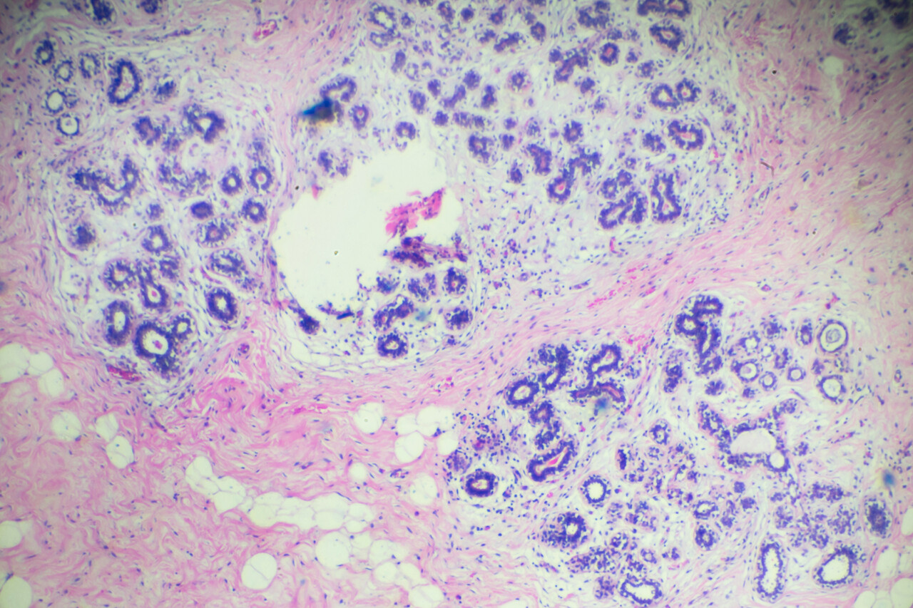 FDA Approves Datopotamab Deruxtecan (Datroway) for HR+, HER2− Breast Cancer