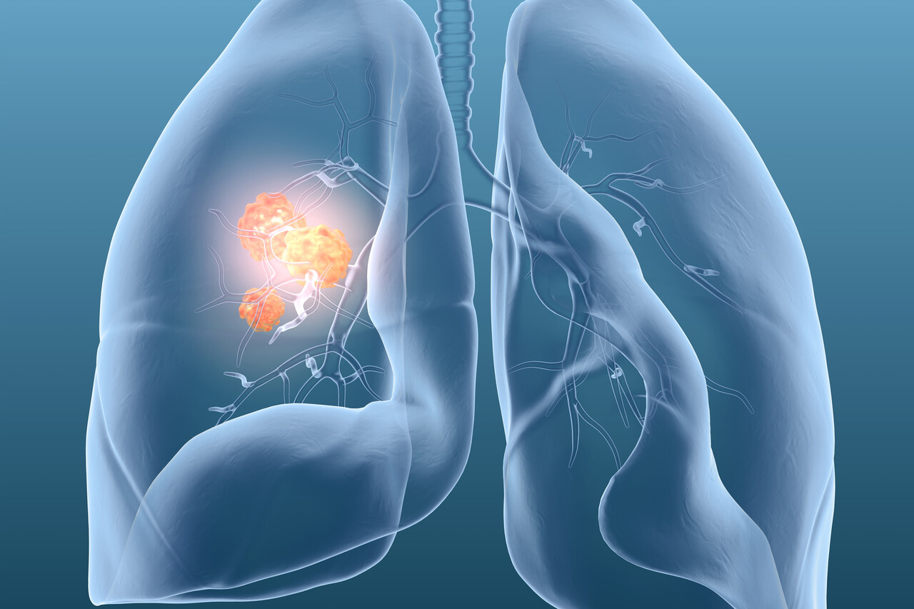 LAURA Study: Osimertinib Improves PFS in Patients with EGFR-Mutated NSCLC