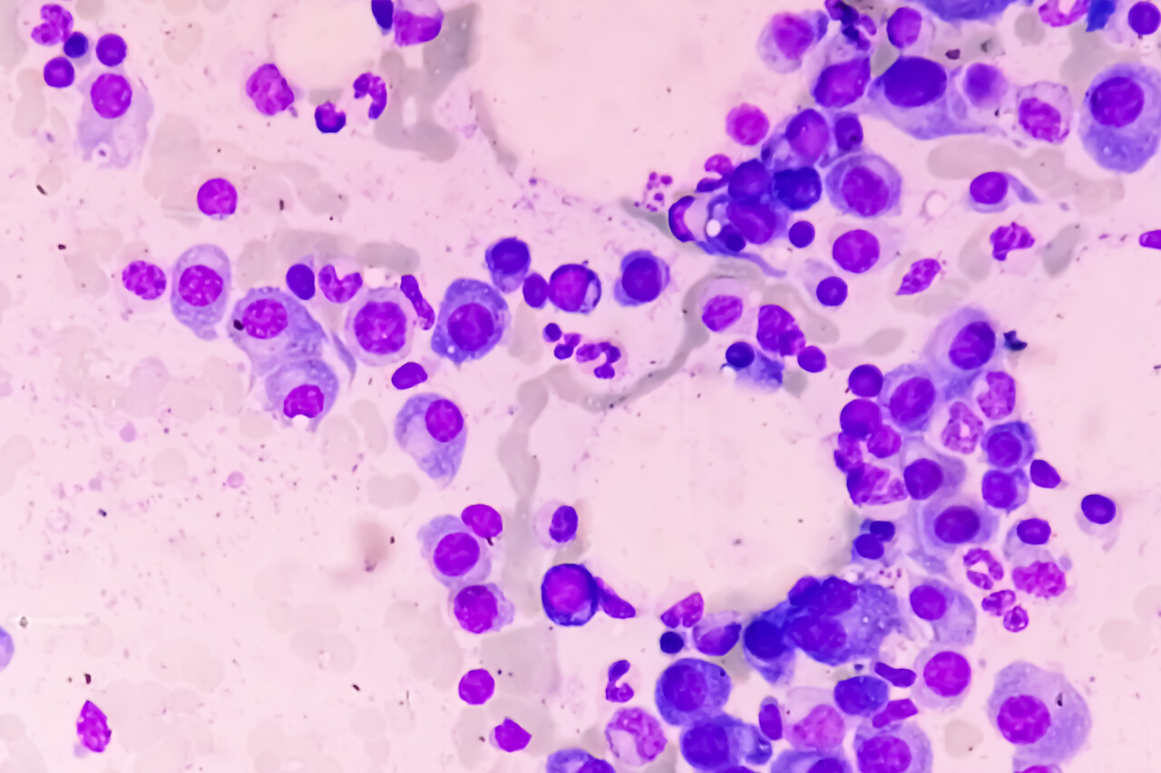 Myeloma Study Sparks Debate Over MRD as Surrogate Endpoint