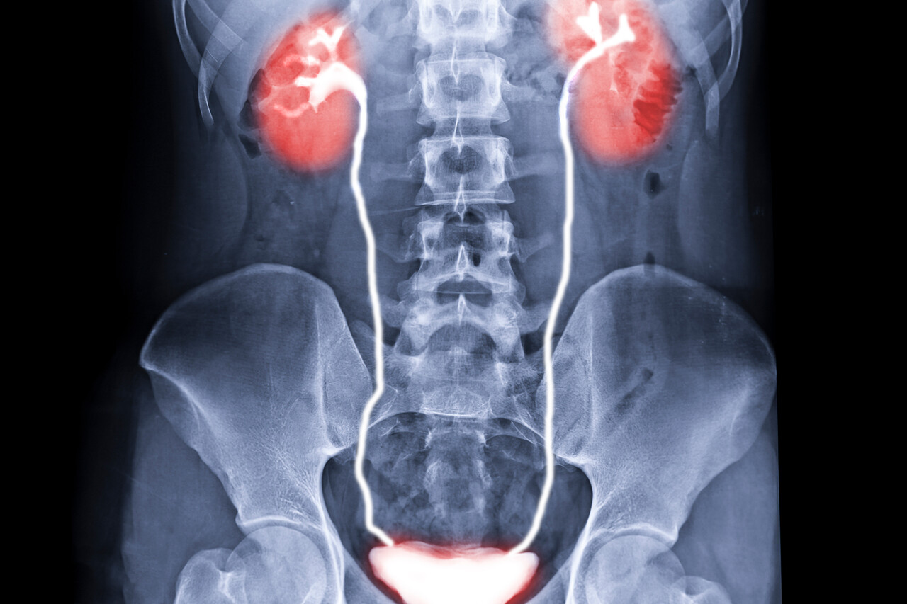 Mismanagement, Overtreatment Prompt New Urothelial Carcinoma Guidelines