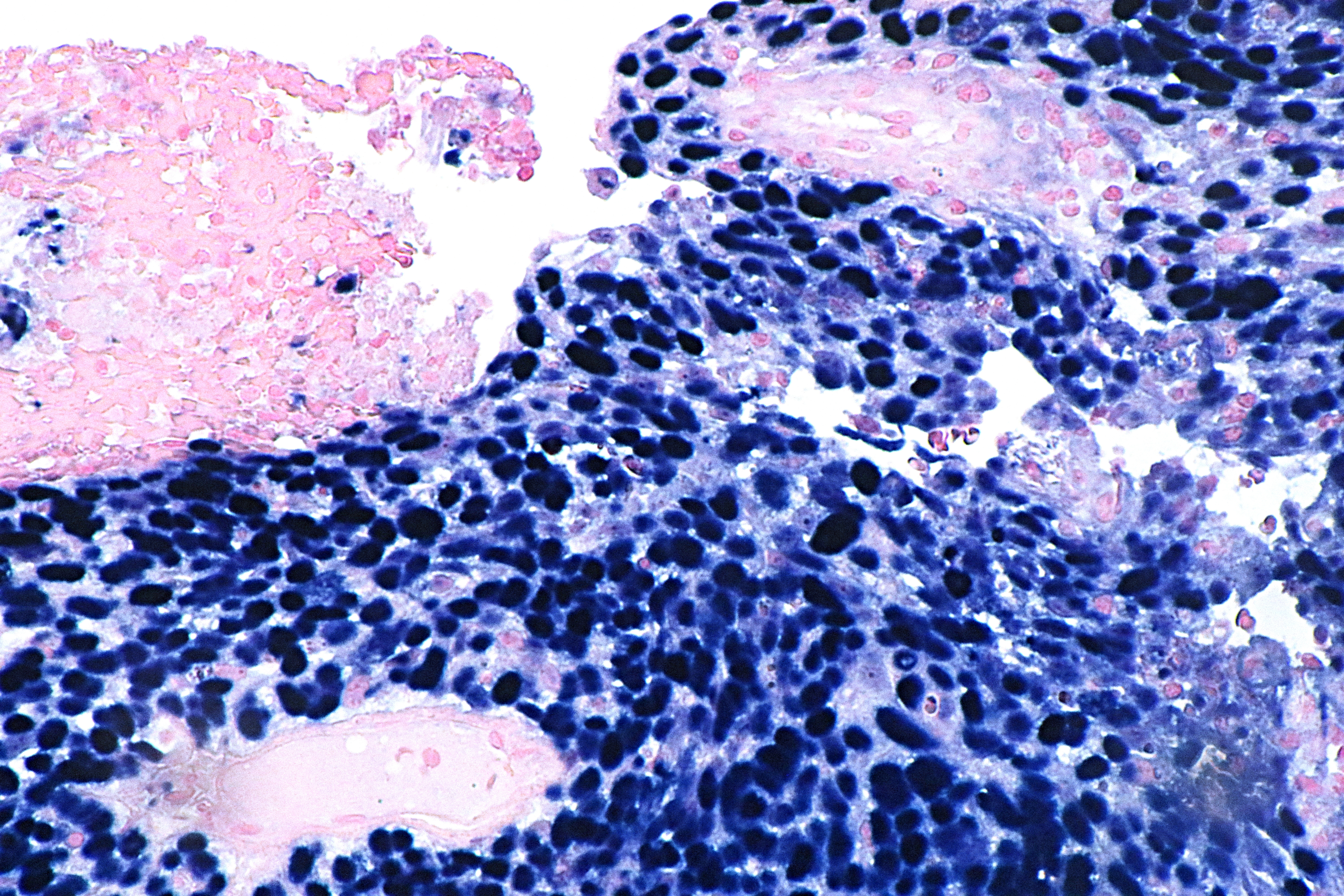 Nasopharyngeal Carcinoma Cytology