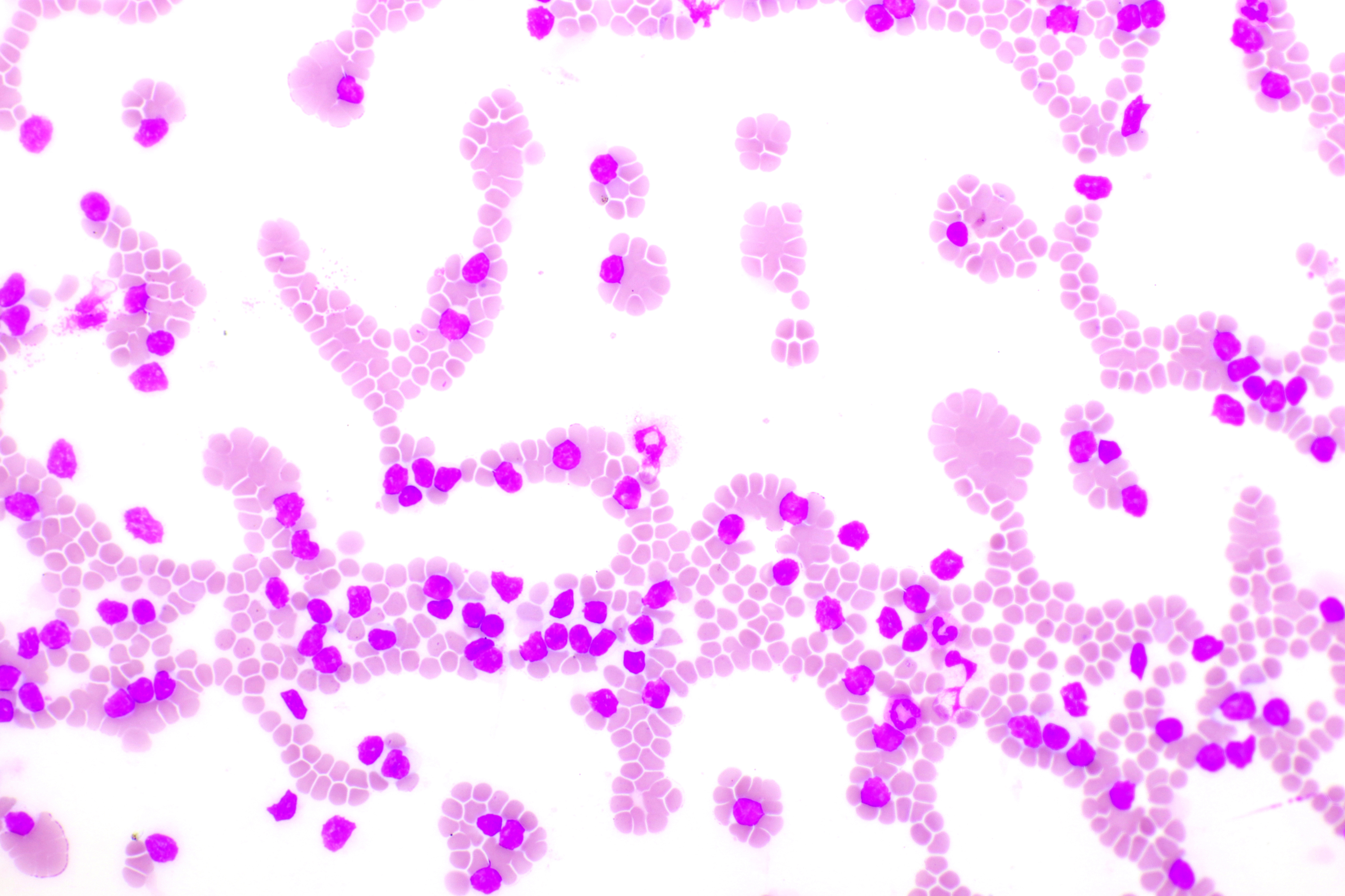 Should VenO Be Extended Beyond One Year in CLL?