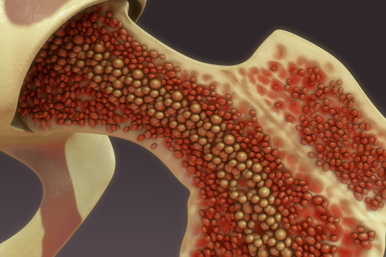 Axatilimab Shows Robust Activity in Chronic Graft-Versus-Host Disease Trial