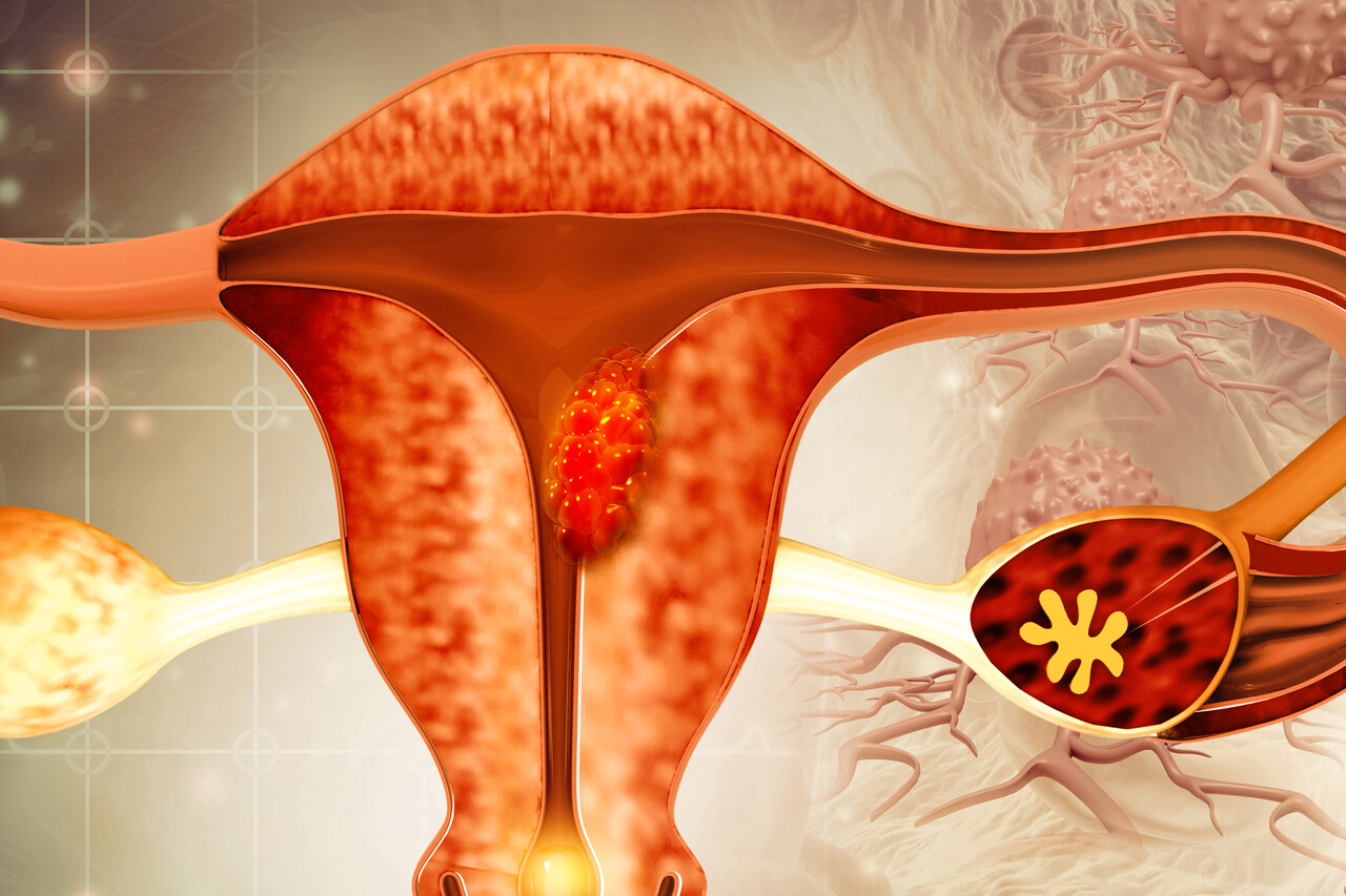 Dramatic Spike in Molecular Testing for Endometrial Cancer Tells ...