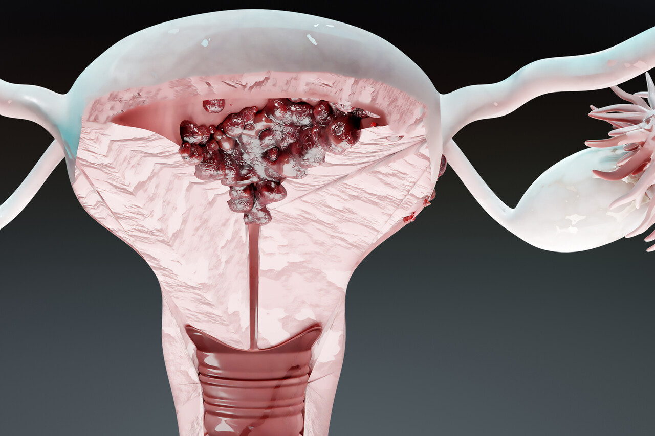 Cervical Cancer: Expert Oncology Information