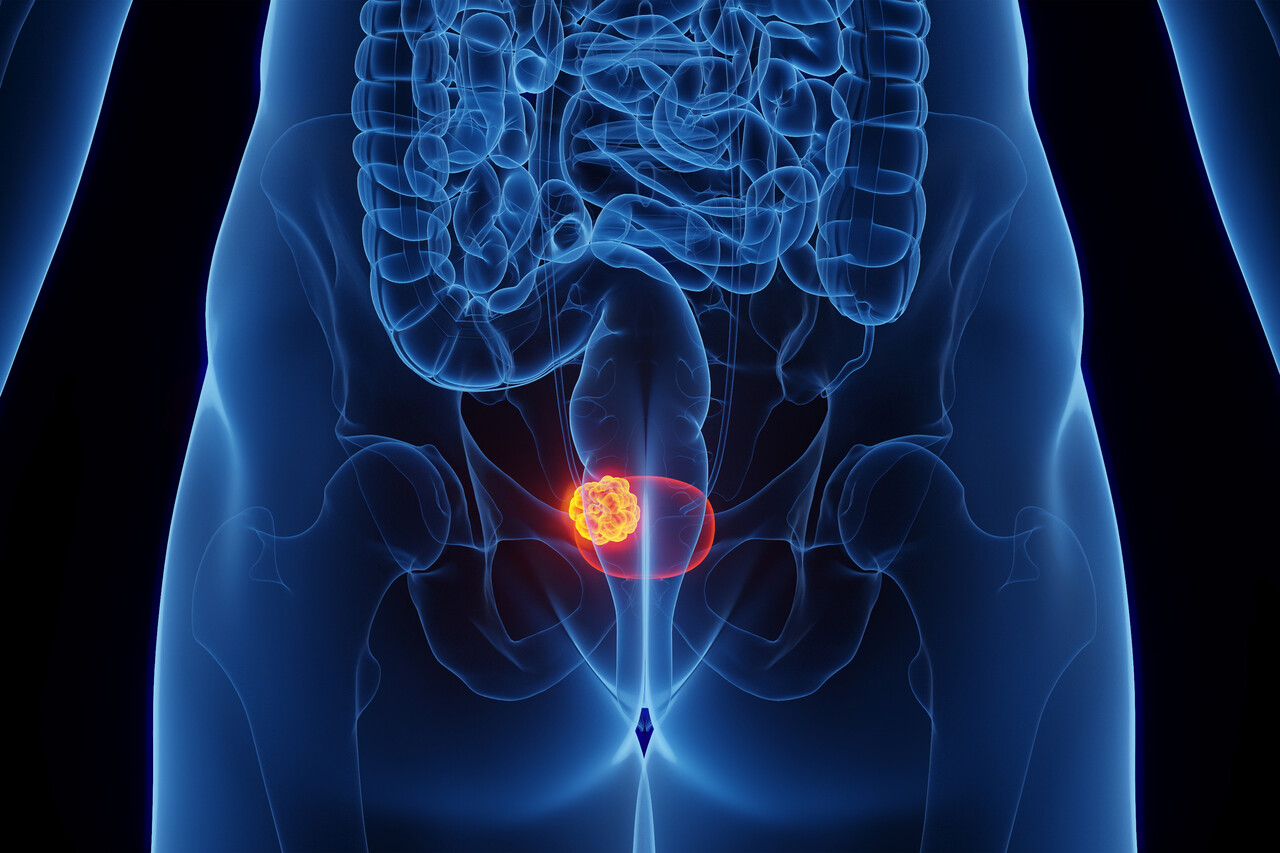 FDA Approves Mitomycin Intravesical Solution (Zusduri) for Non-Muscle ...