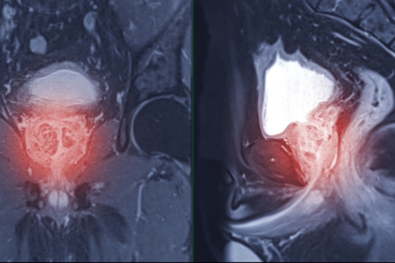 Drug Combo Changes Practice in Prostate Cancer: PEACE-III Data From ...