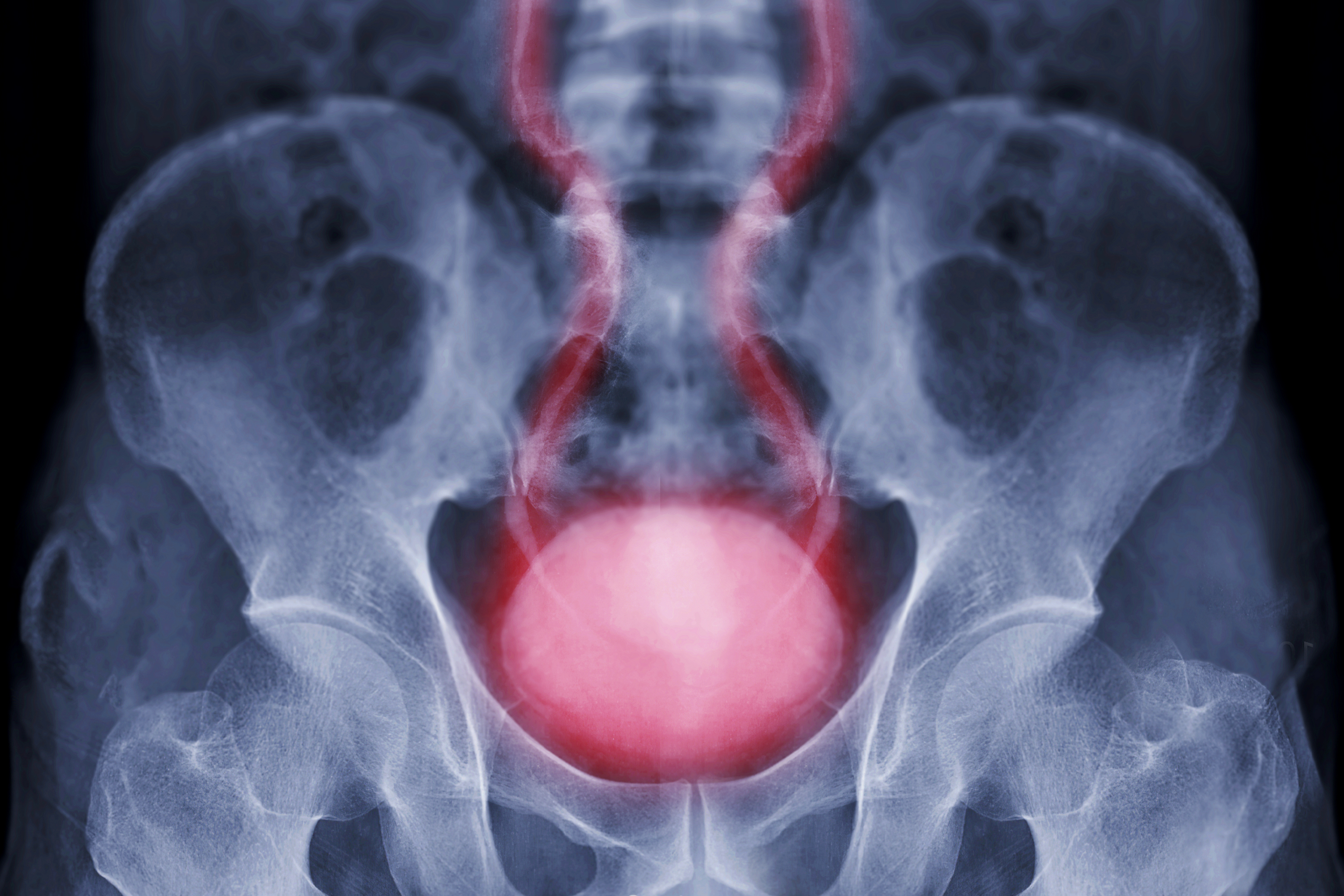 FDA Approves Gemcitabine Intravesical System for Bladder Cancer