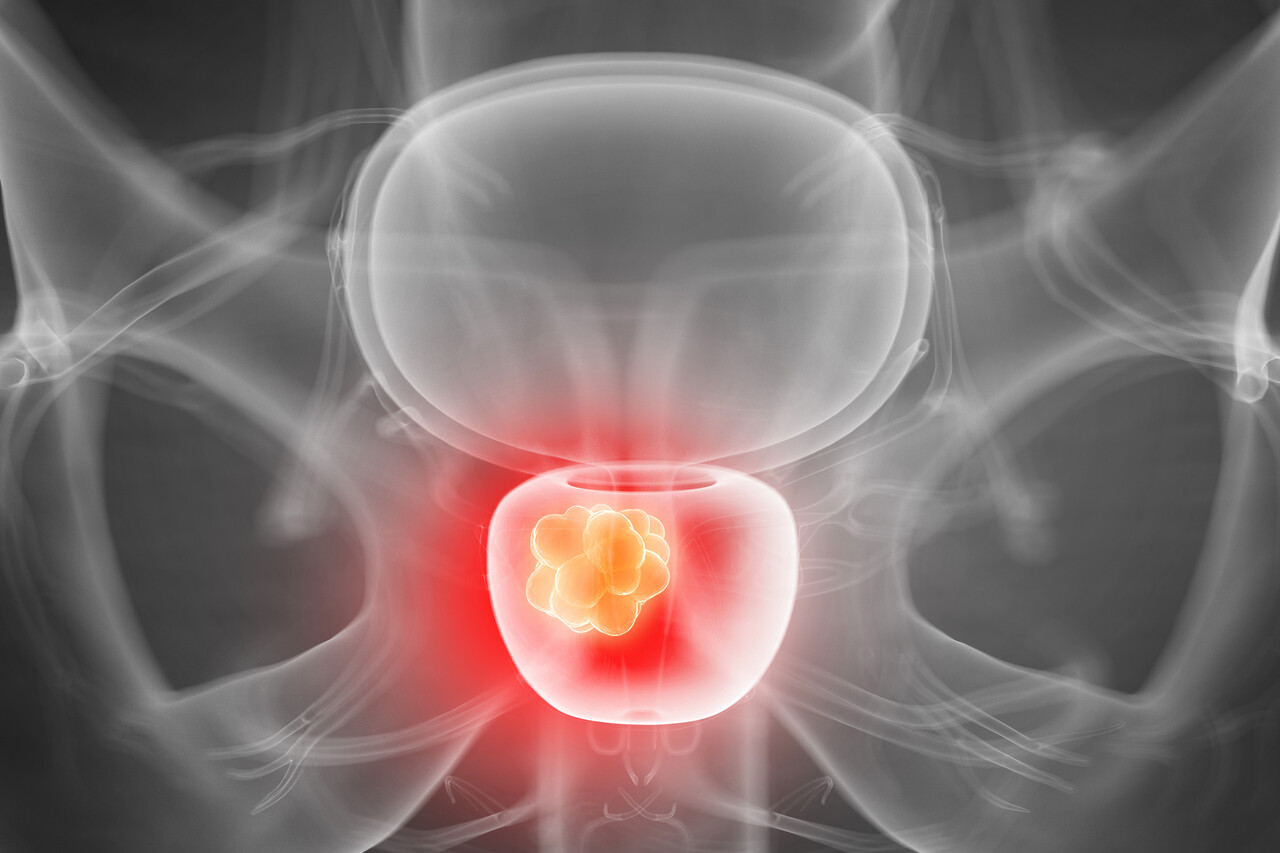 Efficacy and Quality of Life No Longer at Odds in High-Risk Prostate ...