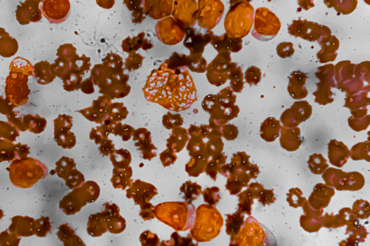 FDA Grants Accelerated Approval to Asciminib (Scemblix) for Chronic ...