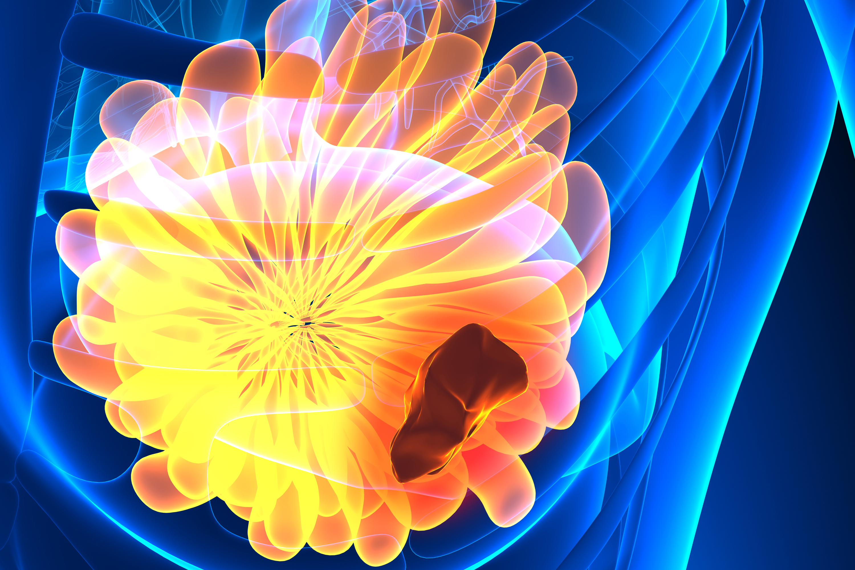 Vepdegestrant Improves PFS in ESR1-Mutated ER-Positive, HER2-Negative ...