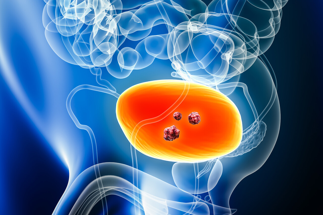 FDA Approves Mitomycin Intravesical Solution (Zusduri) for Non-Muscle ...