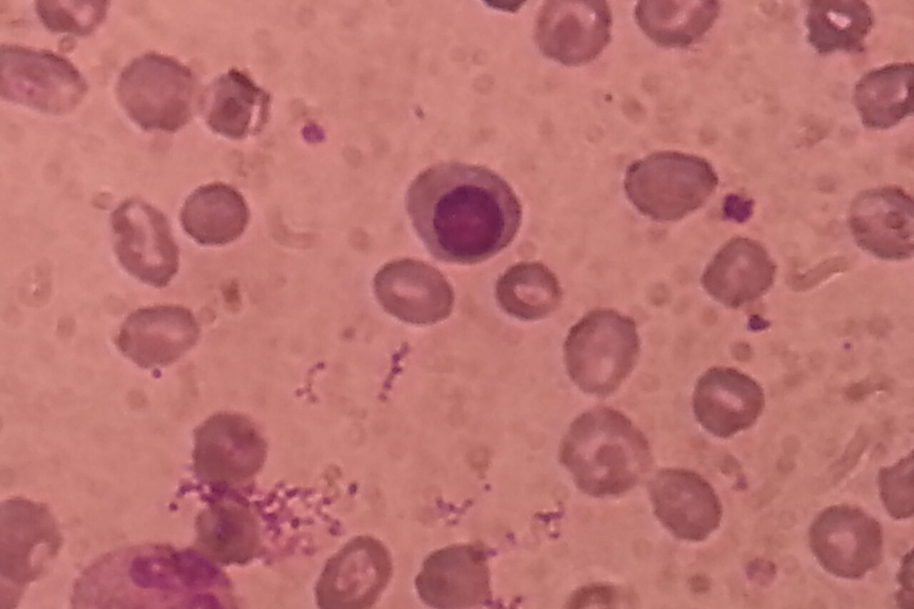 FDA Approves First Cellular Therapy for Severe Aplastic Anemia