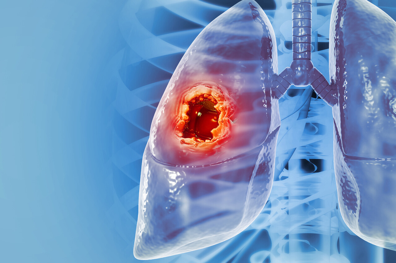 FDA Approves Tarlatamab (Imdelltra) for Small Cell Lung Cancer