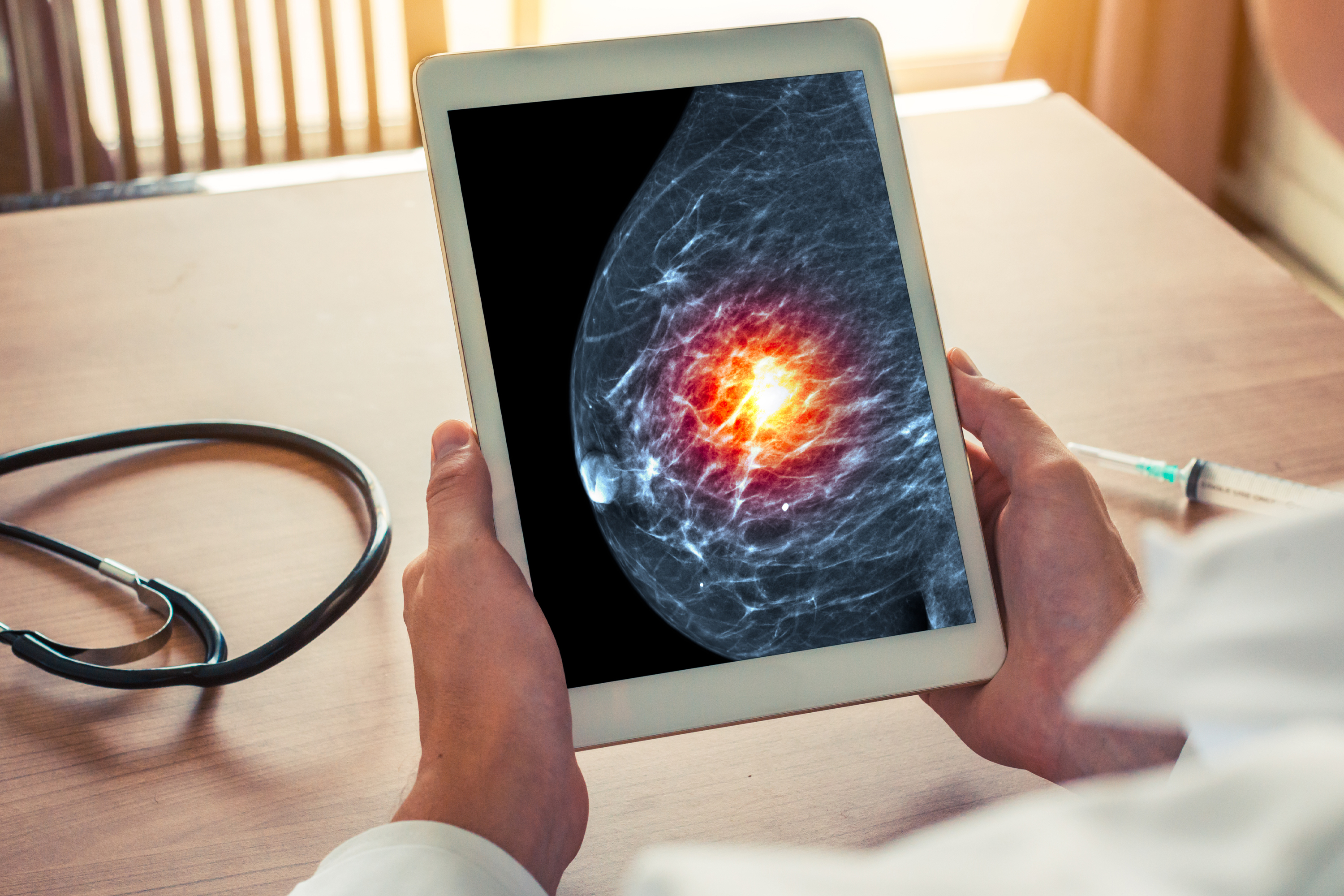 Questions About ESR1 Testing in Breast Cancer Pile Up