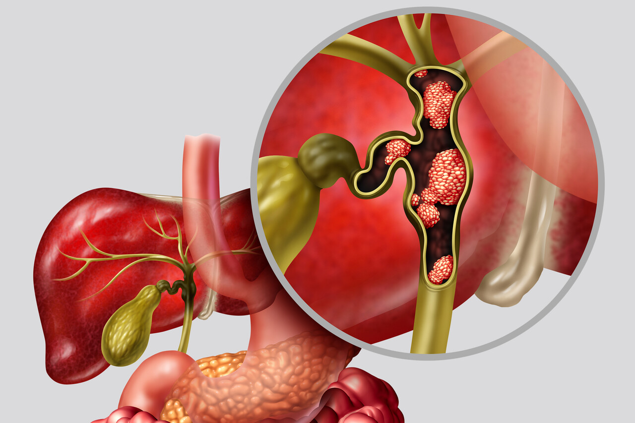 FDA Approves Zanidatamab (Ziihera) for Biliary Tract Cancer