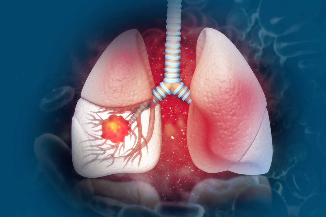 Real-World Data Back First-Line Treatment for Extensive-Stage SCLC