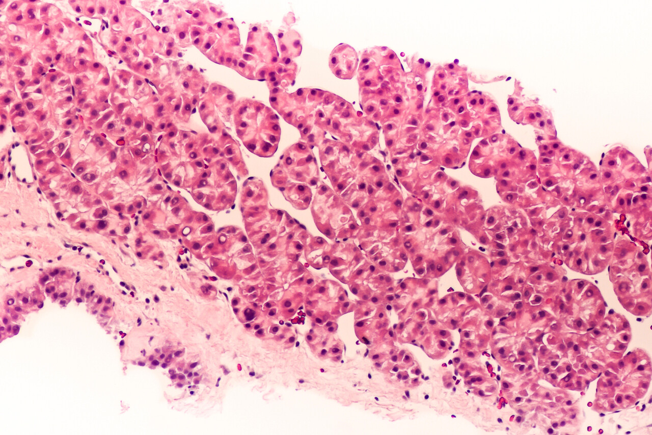 STRIDE Regimen Shows Continued Survival Benefit for Unresectable HCC