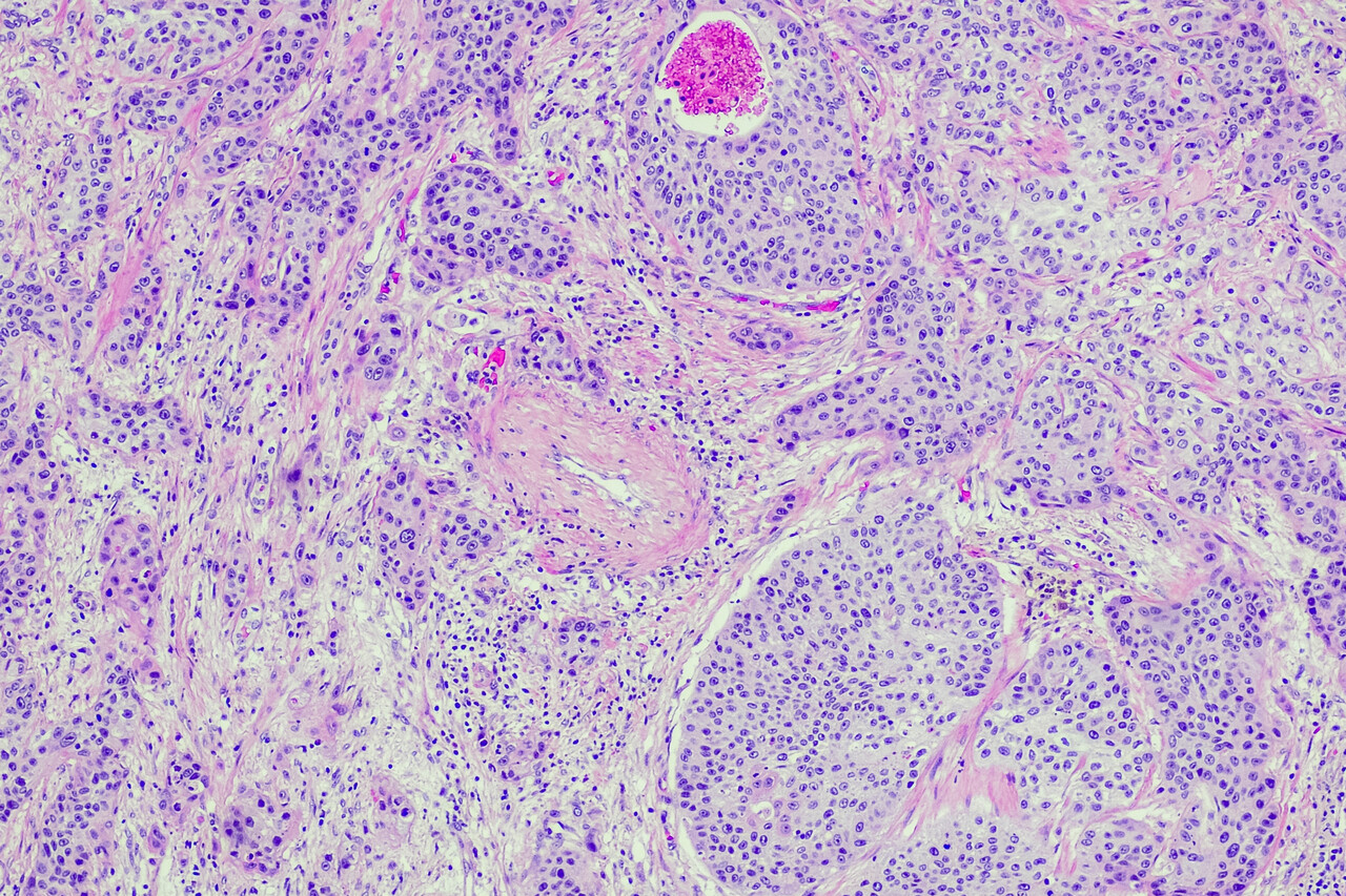 FDA Approves Nivolumab Plus Chemotherapy in Advanced Bladder Cancer