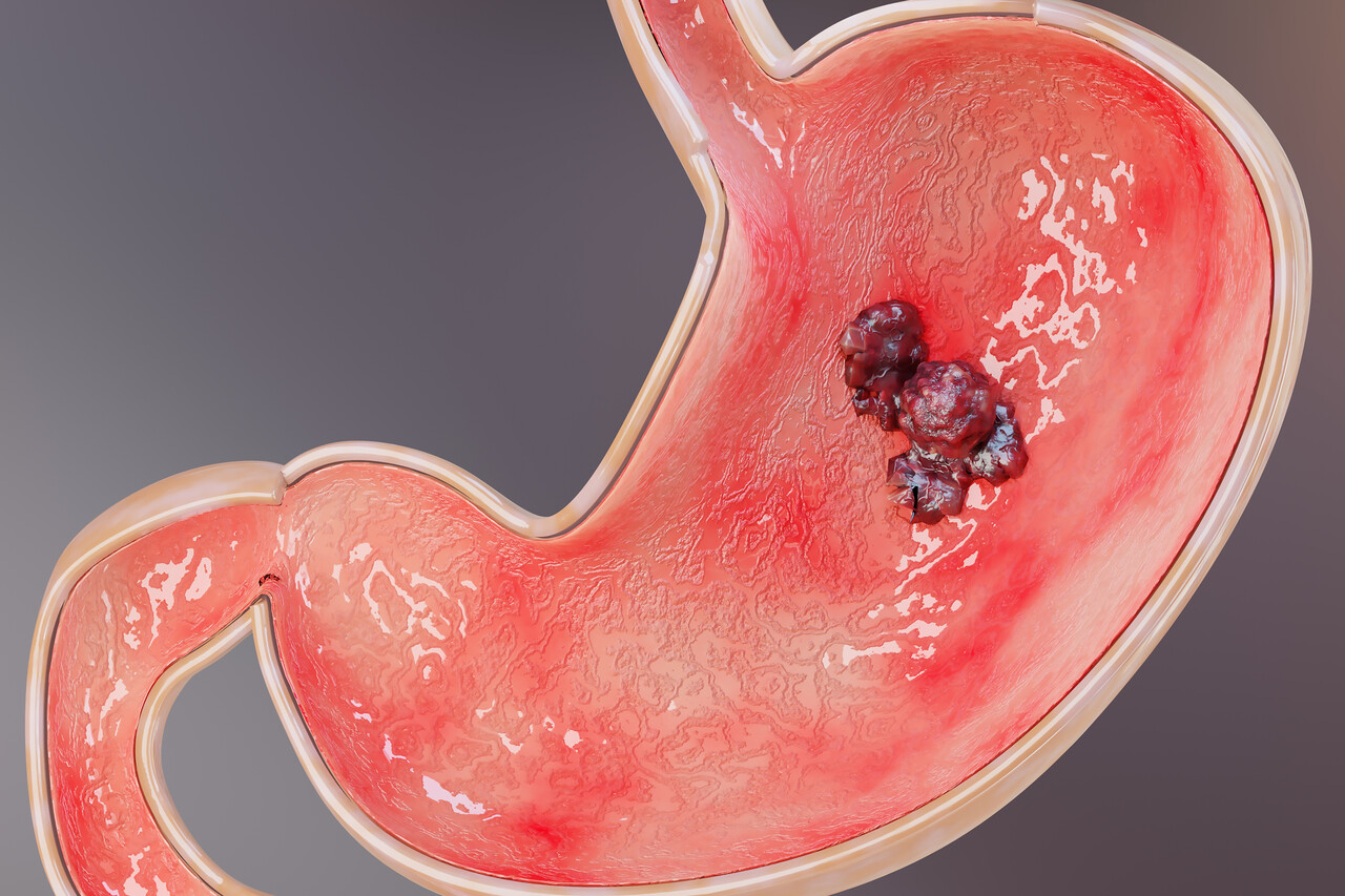 FDA Approves Zolbetuximab (Vyloy) Combo for Advanced, HER2-Negative ...