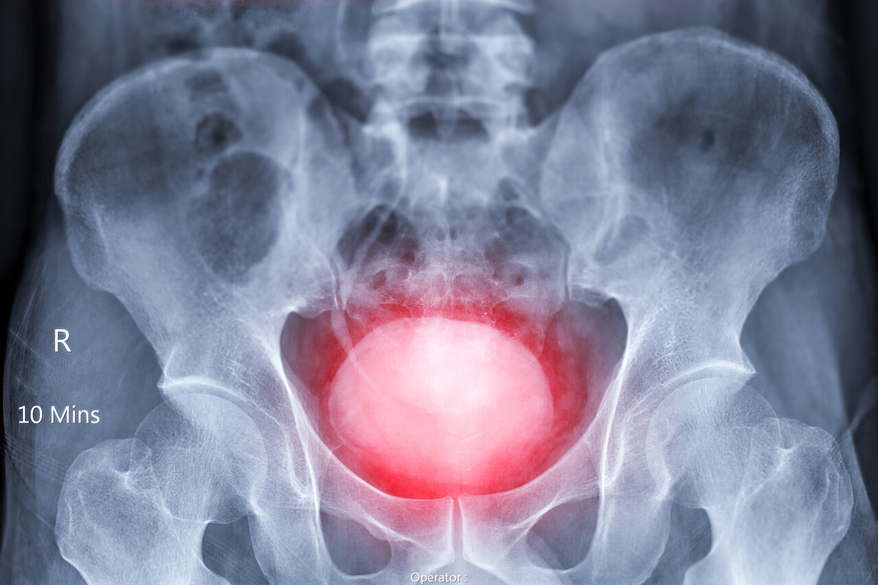 FDA Approves Mitomycin Intravesical Solution (Zusduri) for Non-Muscle ...