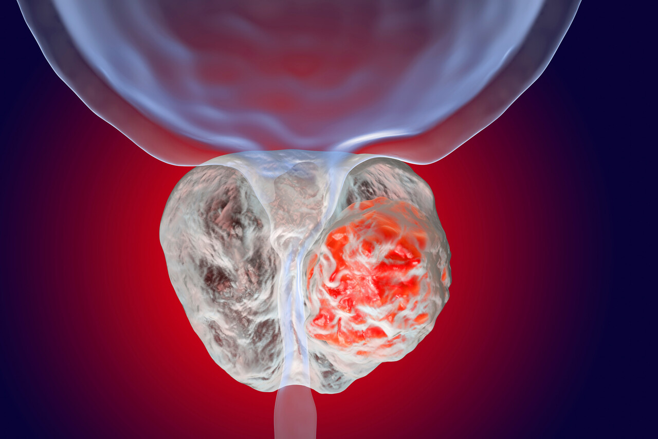 177Lu-PSMA-617 (Pluvicto) a “Chess Piece” for Metastatic Castration ...